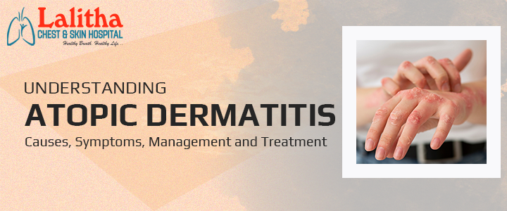 Atopic Dermatitis Explained: Symptoms, Causes & Treatments